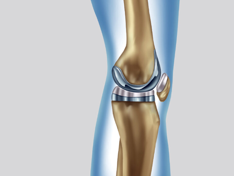 Comment soigner l’arthrose du genou par prothèse articulaire