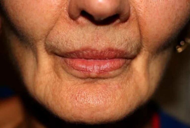 Comment corriger les joues creuses ? - Zenmed Tunisie